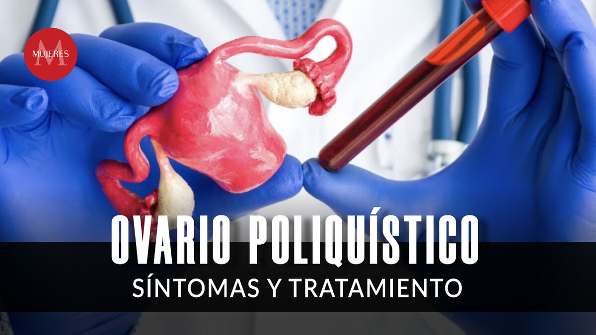 Ovario Poliquístico: Qué es, cuáles son los síntomas y tratamiento